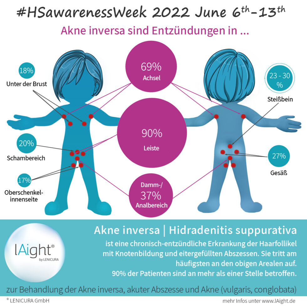 Akne inversa – Die unbekannte Krankheit unter der Haut - LAight Therapie